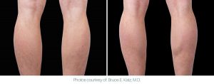 Emsculpt NEO - Thrive Med Spa