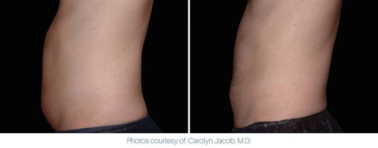 Melt Away Fat & Build Muscles with Emsculpt Neo in New Jersey